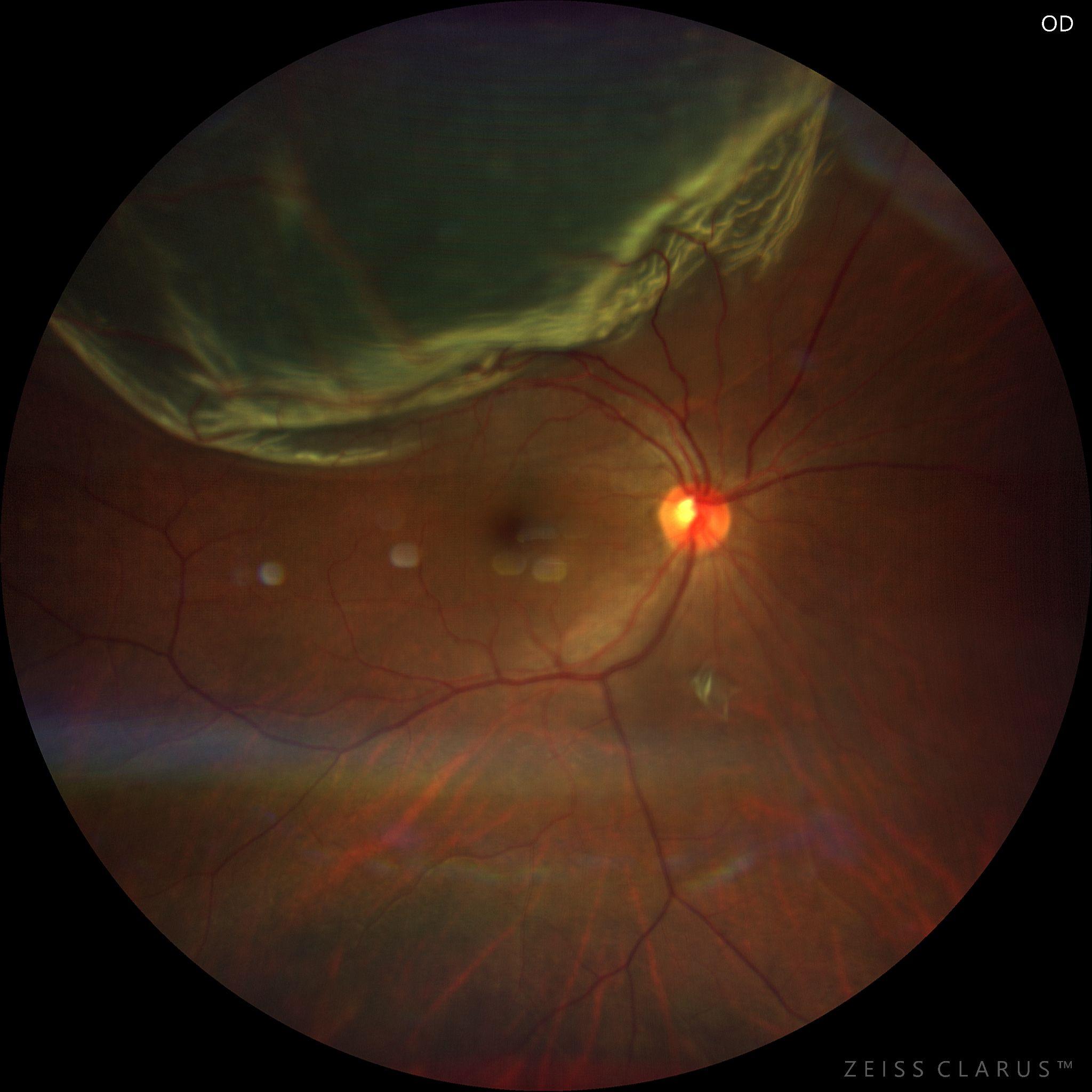 ¿Qué es un desprendimiento de retina? - APEC Blog